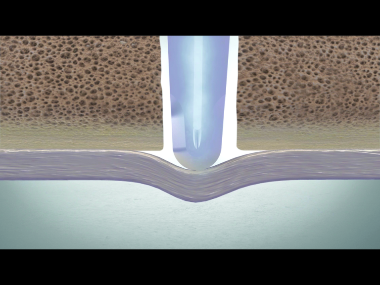 Cortador Ultrasónico BoneScalpel Misonix - Varlix