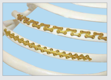 Sistema L1 Rib (costillas) KLS Martin - Varlix