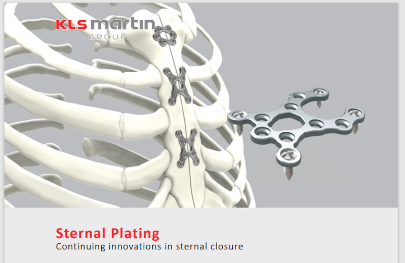 Sistema de placas para cierre esternal KLS Martin - Varlix