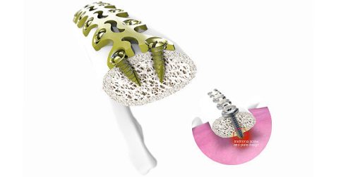 Sistema L1 Rib (costillas) KLS Martin - Varlix