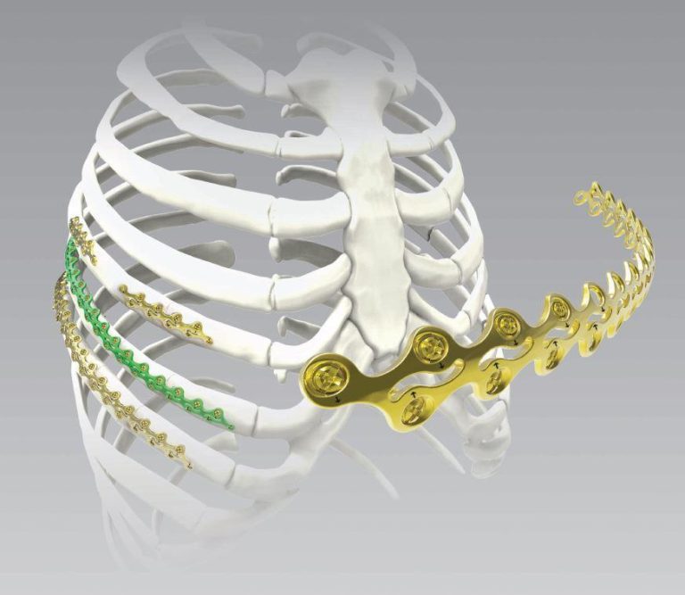 Sistema L1 Rib (costillas) KLS Martin - Varlix