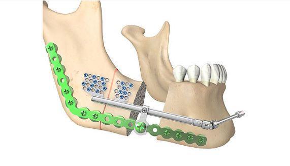 Distractor mandíbular osteogénica KLS Martin - Varlix