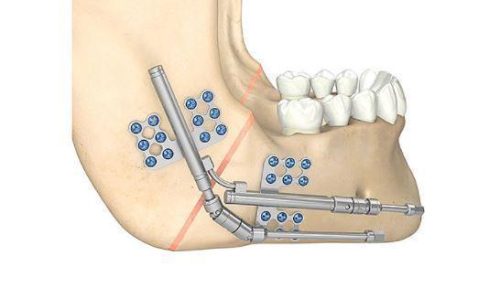 Distractor mandíbular osteogénica KLS Martin - Varlix