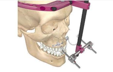 Distracción Osteogénica Para Tercio Medio Facial Kls Martin