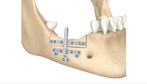 Distractor mandíbular osteogénica KLS Martin - Varlix