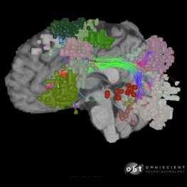 Mapeo Cerebral Quicktome® Omniscient Neurotechnology - Varlix